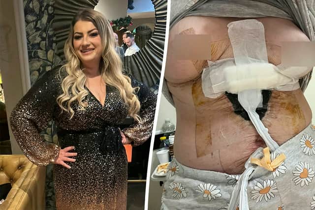 Woman Left ‘butchered After ‘botched Cosmetic Surgery In Turkey